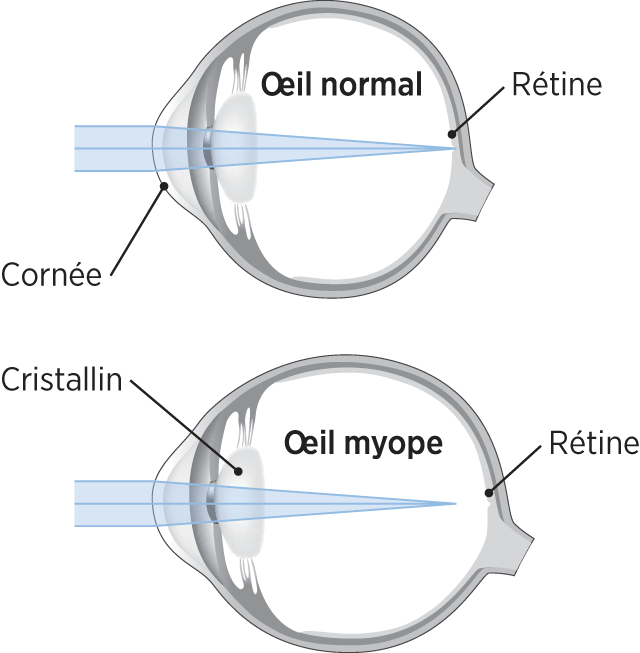 Francais | Contrôler la myopie chez les enfants grâce à une lentille…